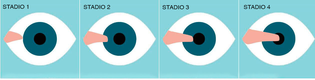 Pterigio: cause, sintomi e trattamento - Vivere più sani