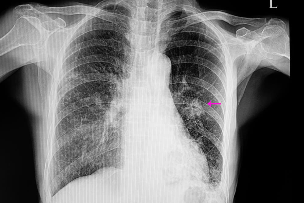 Nodulo Polmonare Diagnosi E Cura Vivere Pi Sani Nodulo Polmonare Diagnosi E Cura Vivere Pi Sani